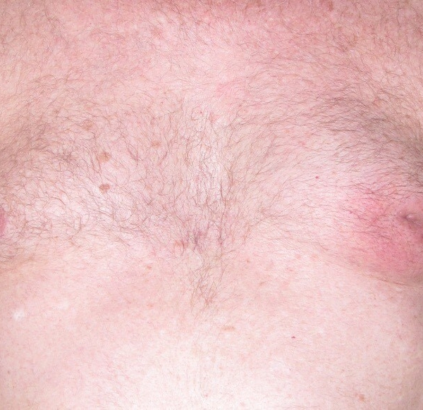 Symptoms – Inflammatory Breast Cancer Research Foundation